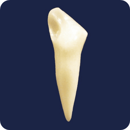 Maxillary Incisor - Class III Fracture | Dental Training Models | DRSK