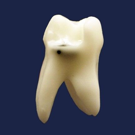 Tooth Restoration Model | Dental Training Models | DRSK