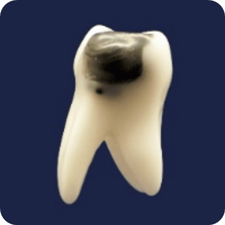 Maxillary Molar - Class II Amalgam Filling & Carious Lesion | Dental ...